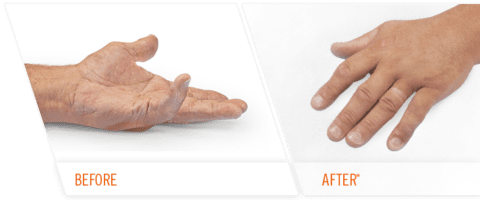 Xiaflex - Lowcountry Orthopaedics & Sports Medicine